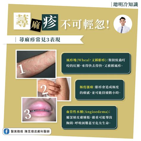 24歲女「蕁麻疹發作」急打針才救回！醫示警5症狀：嚴重恐插管 Ettoday健康雲 Ettoday新聞雲