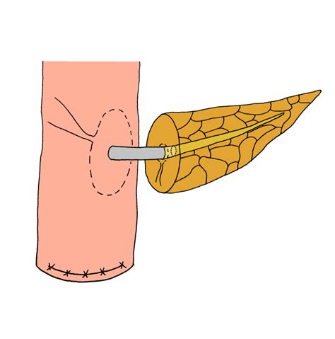 Purse String Suturing Technique The Pancreatic Anastomosis