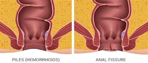 Hemorrhoids And Anal Fissures