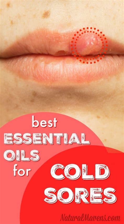 What Are The Best Essential Oils For Cold Sores Natural Mavens