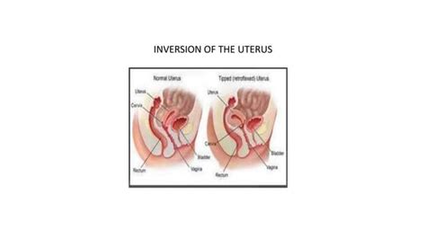 Inversion Of The Uterus Pptx