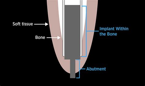 Osseointegration Health Mil