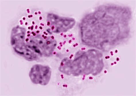 a dangerous ‘silent reservoir for gonorrhea the throat the new