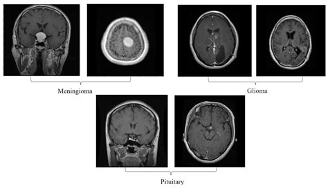 Diagnostics Free Full Text Grade Classification Of Tumors From