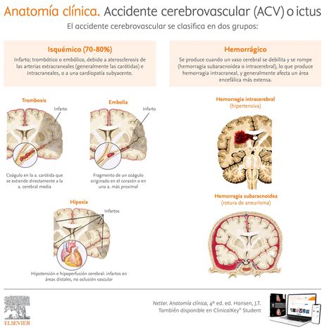 Anatomía Clínica Del Accidente Cerebrovascular Acv O Ictus