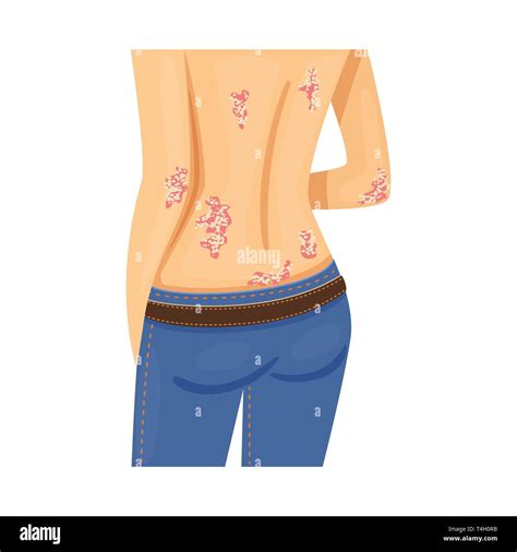 Isolated Object Of Psoriasis And Skin Icon Collection Of Psoriasis And