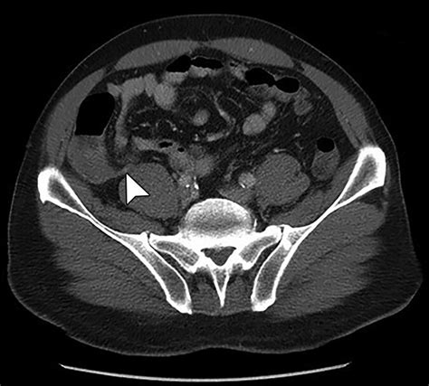 Prevalence Of Appendicoliths Detected At Ct In Adults With Suspected