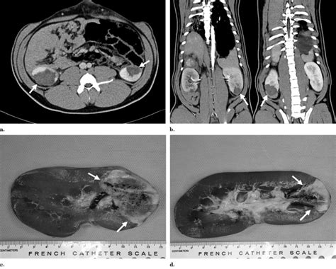 Radiofrequency Renal Ablation In Vivo Comparison Of Internally Cooled