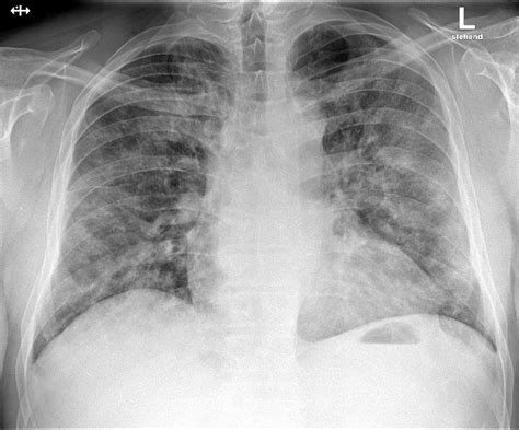 Posteroanterior Chest X Ray At Admission Demonstrating Bilateral