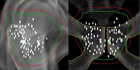 Locations Of Implanted Fiducial Markers In 23 Patients Need For Set Up