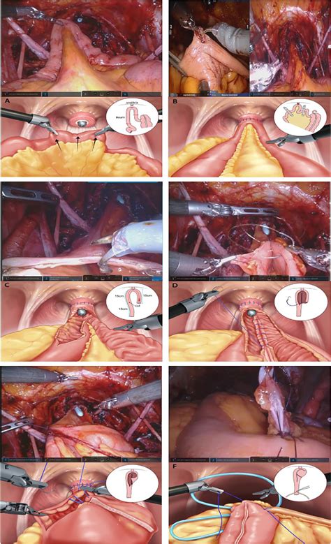 Figure 1 From The Learning Curve For Robot Assisted Radical Cystectomy