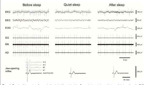Figure 1 From Jaw Opening Reflex And Corticobulbar Motor Excitability