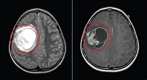High Grade Glioma Pediatric Brain Tumor Portal