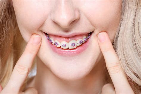 Invisalign Versus Braces Which Is Faster La Dental Clinic