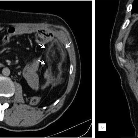 Contrast Enhanced Abdominal Computed Tomography Image A Axial B