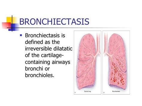 Pathogenesis Of Bronchiectasis By Dr Bashir Ahmed Dar Associate Profe…
