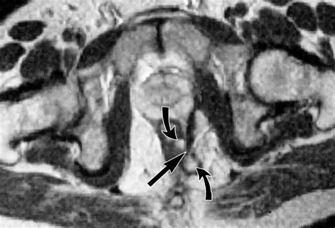 Mr Imaging Classification Of Perianal Fistulas And Its Implications For