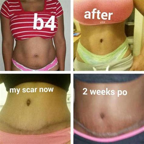 Pictures Of Tummy Tuck And Lipo Before And After Tummy Tuck Prices