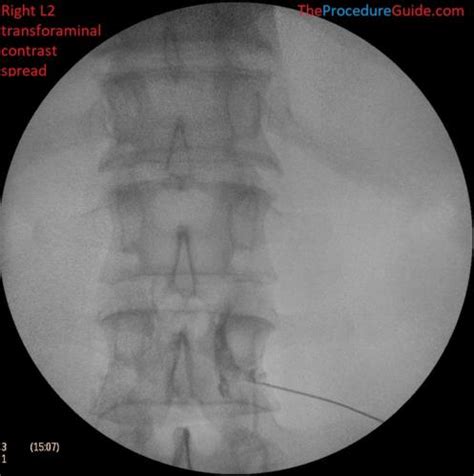 Fluoroscopic Guided Piriformis Injection Technique And Overview The