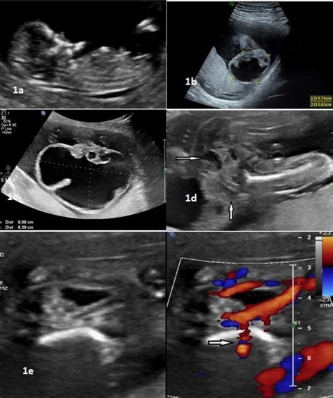 Fetus With Sct 19 Weeks Of Gestational Age 1a Normal First