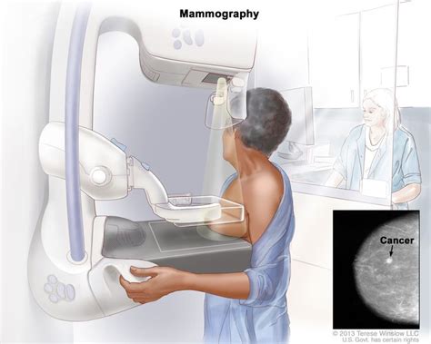 Breast Cancer Screening Nci