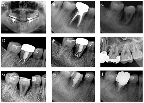 Medicina Free Full Text Long Term Survival Rate Of Autogenous Tooth