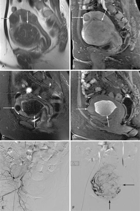 Image Based Interventional Therapies For Benign Uterine Neoplasms
