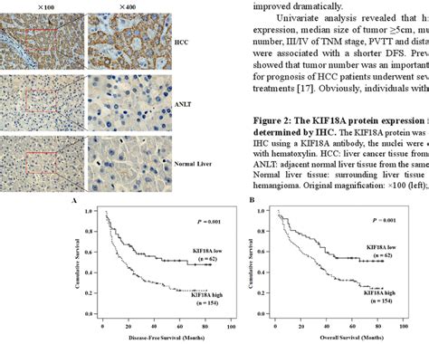 The Relationship Between Kif18a Expression And Dfs Or Os Patients With
