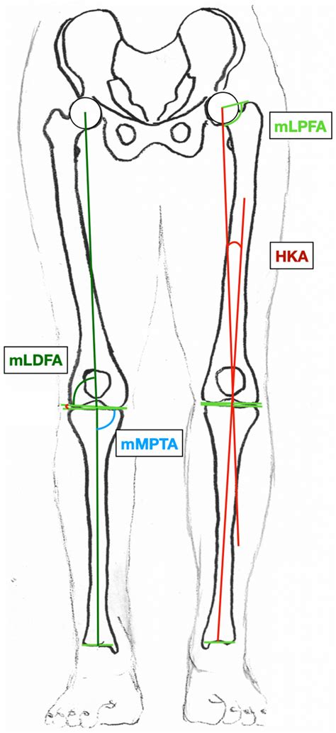 The Radiographic Parameters Measured On A Long Leg Standing X Ray With