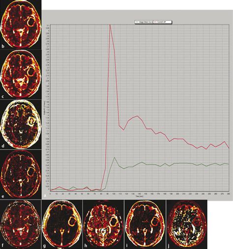 5 Perfusion Imaging Dynamic Contrast Enhanced T1 Weighted Mri Dce Mri