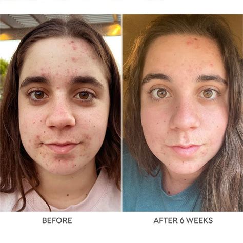 Dr Zenovia Skincare 5 Benzoyl Peroxide Acne Spot Treatment The Summit