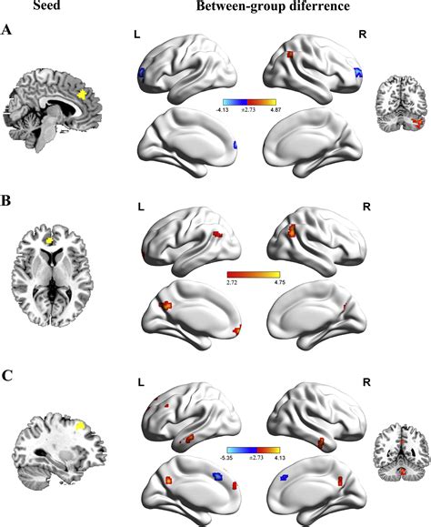 Resting State Functional Connectivity Abnormalities Correlate With
