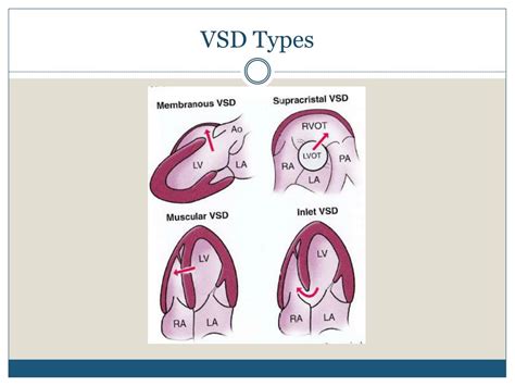 Ppt Ventricular Septal Defects Powerpoint Presentation Free Download