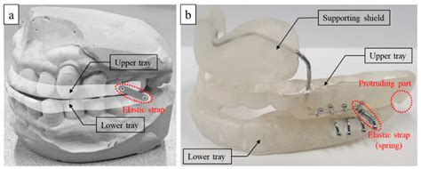 Applied Sciences Free Full Text A Novel Mandibular Advancement