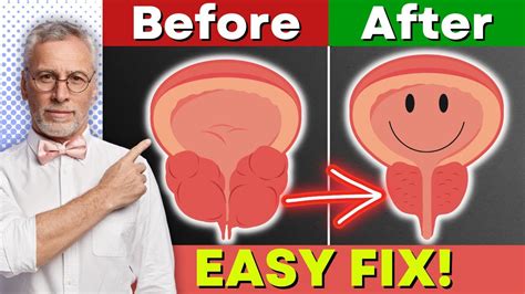Top 6 Foods You Must Avoid To Protect Your Prostate Health Youtube