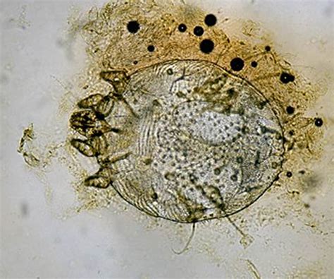 Scabies Mite Under Microscope