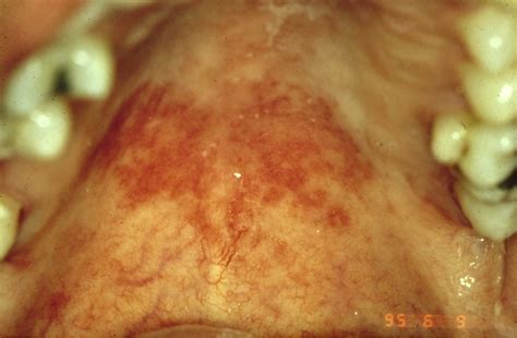 Erythematous Candidiasis