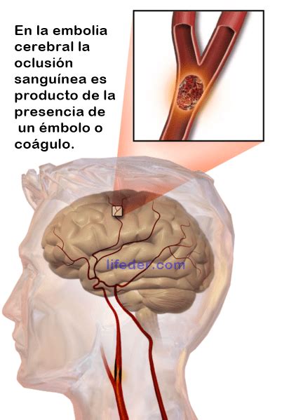 Embolia Cerebral Sintomas Causas Tratamento