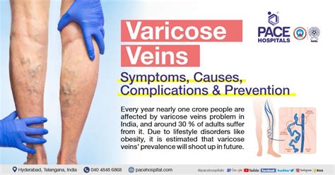 Varicose Veins Causes Symptoms And Treatments Explained Nbkomputer