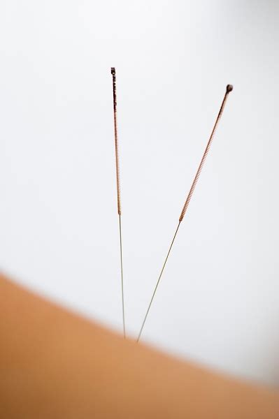 effectiveness of acupuncture for smoking cessation in china d4 clinic