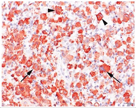 Immunohistochemistry Of The Histiocytic Sarcoma With Prominent