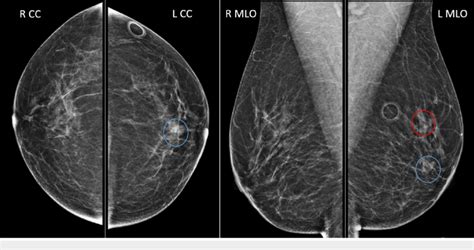 Screening Mammogram 6 Mm Asymmetry In The Upper Region Red Circle 10