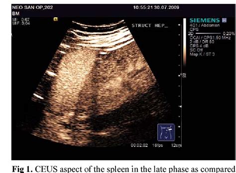 Figure 1 From The Role Of Contrast Enhanced Ultrasonography With Second