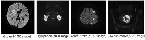 Diffusion Weighted Mri Dwi Mri Sequence Physics And Image Appearance