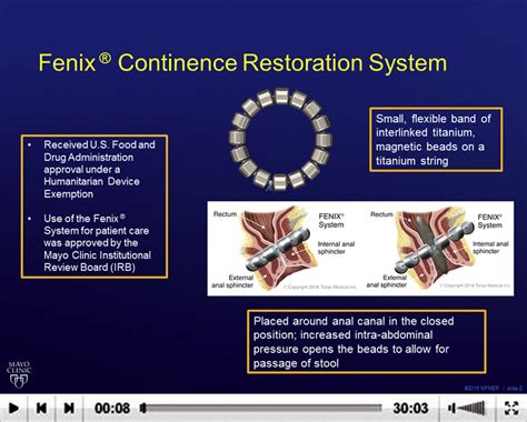 The Fenix System For Fecal Incontinence An Overview And Surgical