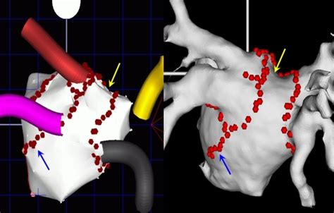 The Electroanatomic Map Of The Left Atrium Using Carto Left Can Be