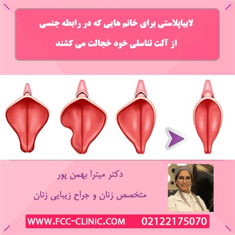 عکس عمل لابیاپلاستی عکس قبل و بعد از لابیاپلاستی دکتر میترا بهمن پور