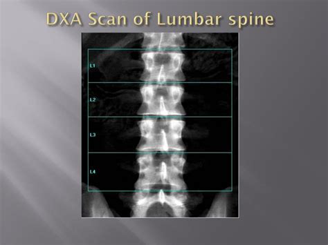 Ppt Bone Density And The Dxa Scanner Powerpoint Presentation Free