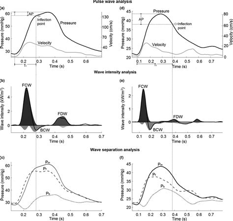 Examples Of Arterial Wave Analyses Arterial Wave Analyses Of Two