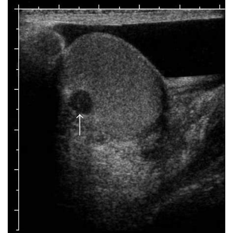 Ultrasound Of The Right Testis Longitudinal View A Hypoechoic Lesion
